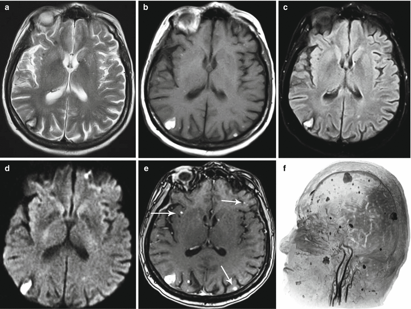 Metastases in the Brain from an Unknown Primary Origin | Radiology Key