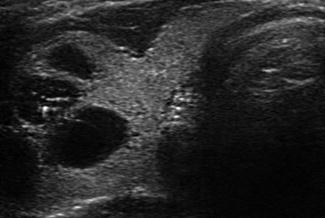 Diffuse Thyroid Disease (DTD) and Thyroiditis | Radiology Key