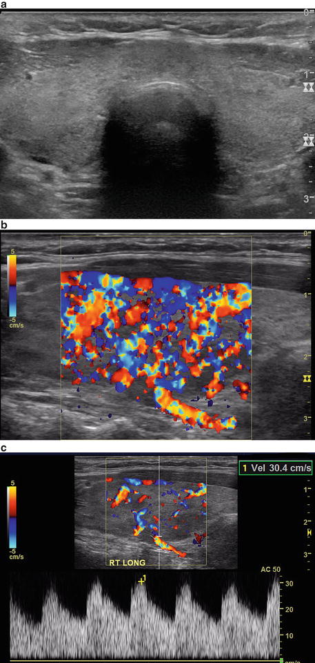 Feature Illustration: Vascularity | Radiology Key