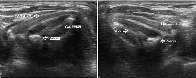 Transcutaneous Laryngeal Ultrasonography: Clinical Variables ...