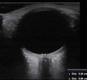 Ocular Ultrasound | Radiology Key