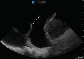 Thoracic Ultrasound | Radiology Key