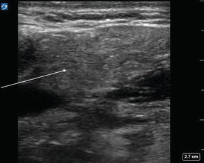 Head and Neck Ultrasound | Radiology Key