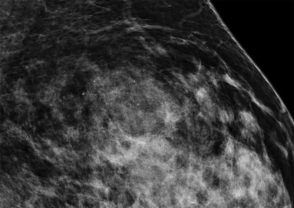 Grouped Calcifications | Radiology Key