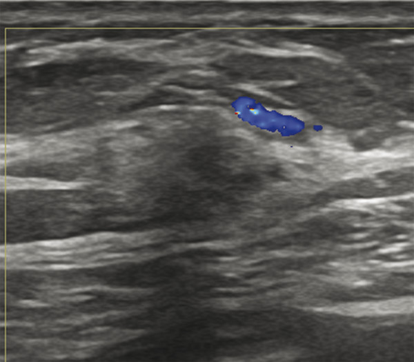High-Density Mass | Radiology Key