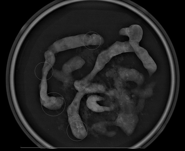 Amorphous Calcifications | Radiology Key
