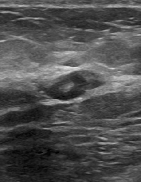 Circumscribed Mass on Baseline Mammogram | Radiology Key