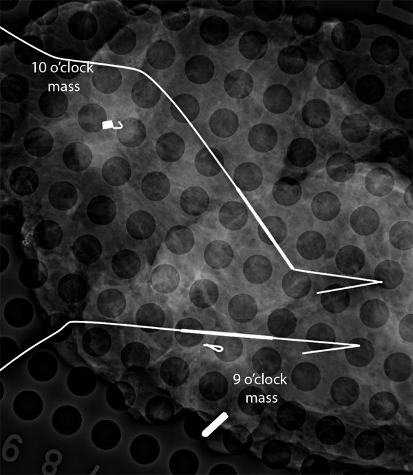 Obscured Mass and Architectural Distortion Findings | Radiology Key