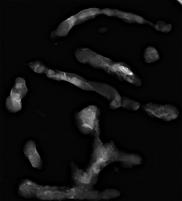 Linear Calcifications | Radiology Key
