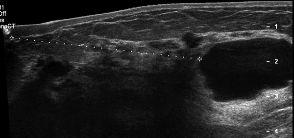 Enlarging Mass | Radiology Key