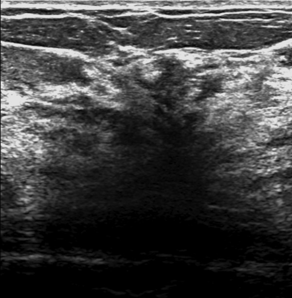 Architectural Distortion within Dense Breast Tissue | Radiology Key