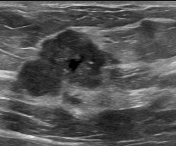 Palpable Mass on First Mammogram | Radiology Key