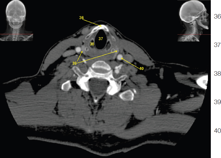 Head and Neck (Extracranial) | Radiology Key