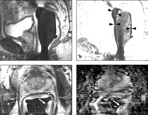 Introduction to Prostate MRI Protocols: Hardware, T2-Weighted Imaging ...
