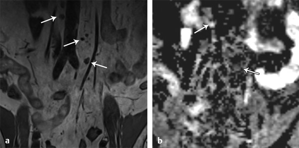 Prostate Cancer Staging and Surgical Planning | Radiology Key