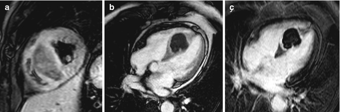 Cardiac Trauma | Radiology Key