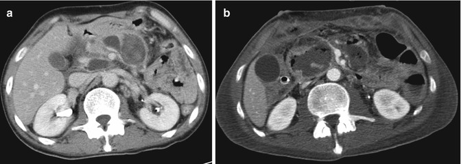 Pancreatic Injuries | Radiology Key