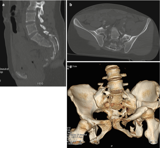 Pelvic Trauma: Vascular/Visceral | Radiology Key