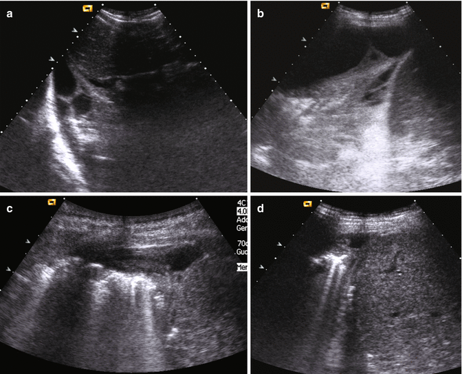 The Follow-Up of Patients with Thoracic Injuries | Radiology Key