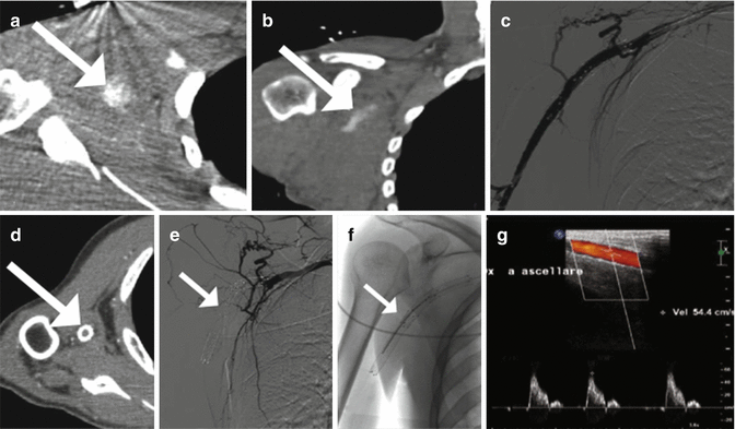 Injuries of the Limbs in Polytrauma: Upper and Lower Limbs | Radiology Key