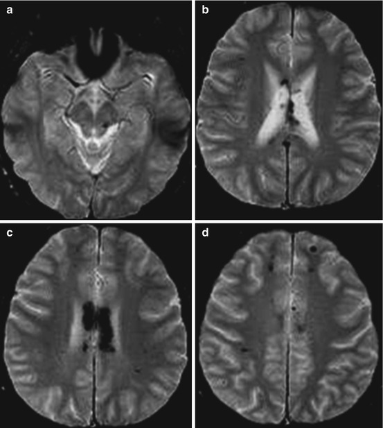 Head Injuries | Radiology Key