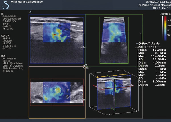 Elastography of the Thyroid Gland | Radiology Key