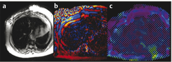 Magnetic Resonance Elastography | Radiology Key