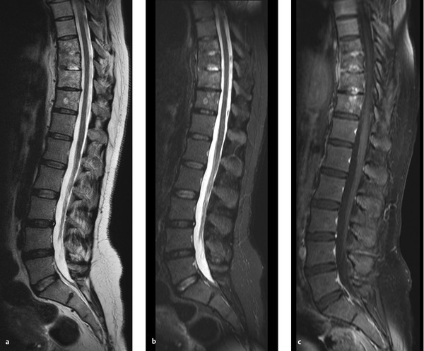 Inflammations, Infections, and Related Diseases | Radiology Key