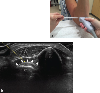 Evaluation of Distal Biceps | Radiology Key