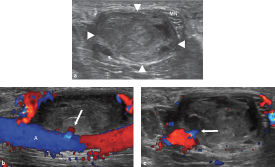 Evaluation of Hand and Finger Masses | Radiology Key