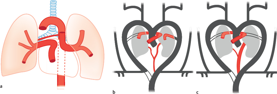 Pulmonary Arteries | Radiology Key