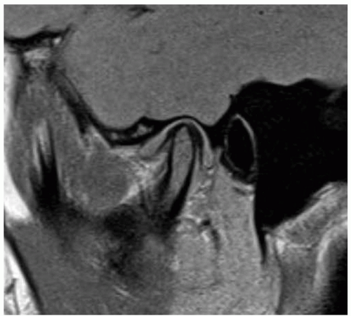 Temporomandibular Joint | Radiology Key
