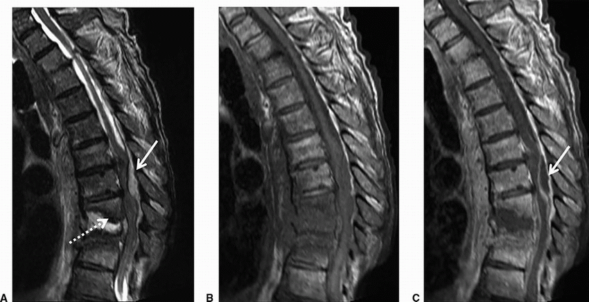 Spine Infection, Inflammation, and Demyelination | Radiology Key