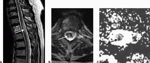 Spine Neoplasms, Spine and Neck Vascular Diseases | Radiology Key
