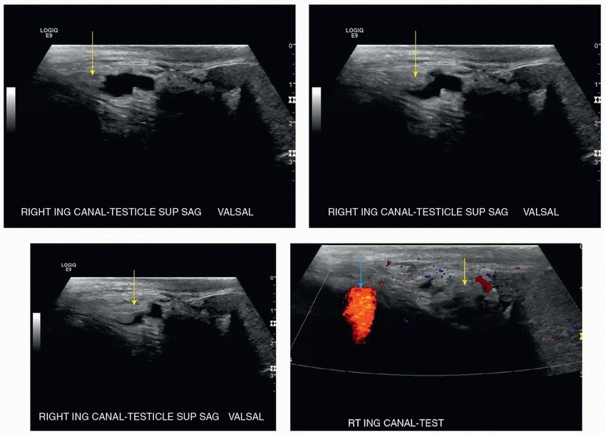 Peritoneal Space, Retroperitoneum, Abdominal Wall, and Chest ...