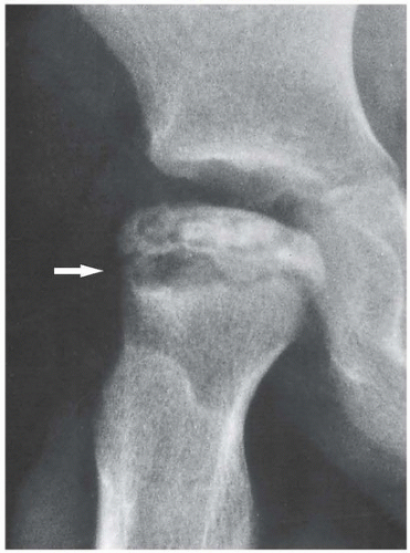 Osteonecrosis (Ischemic or Avascular Necrosis) | Radiology Key
