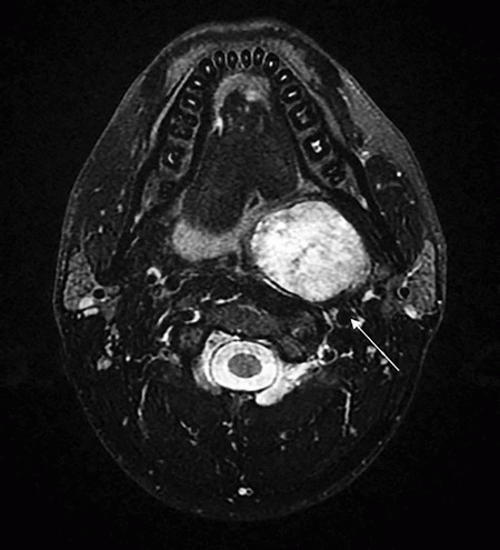 Soft Tissue Neck | Radiology Key