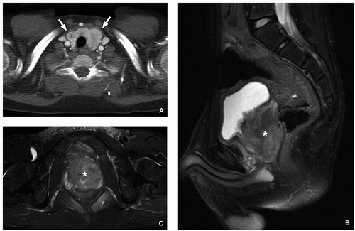 Male Genital Tract | Radiology Key
