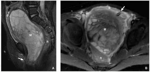 Female Genital Tract | Radiology Key
