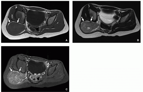 Musculoskeletal Neoplastic Disorders | Radiology Key