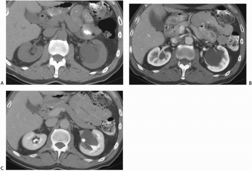 Renal Cystic Disease | Radiology Key