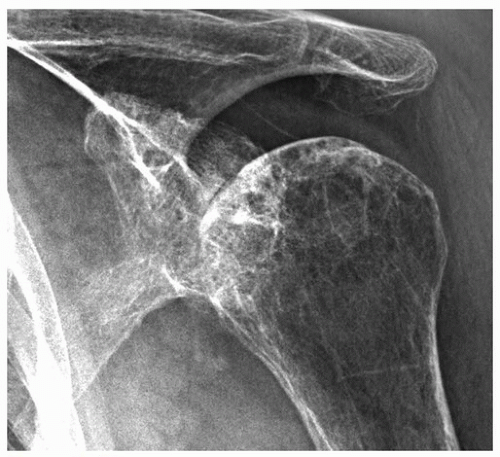 Inflammatory Arthritides Radiology Key