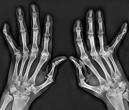 Connective Tissue Arthropathies | Radiology Key