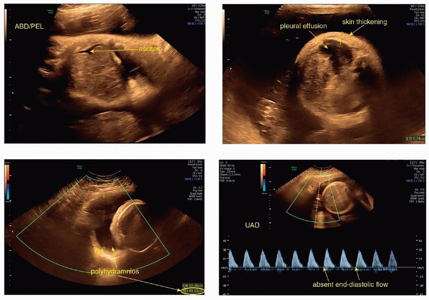Second and Third Trimester Pregnancy | Radiology Key