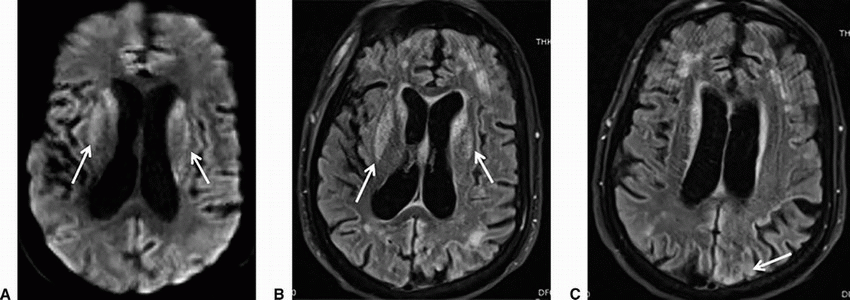 CNS Imaging Manifestations of Toxic, Metabolic, and Systemic ...