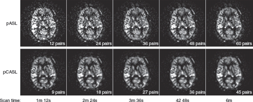 Arterial Spin Labeling Acquisition Protocols | Radiology Key