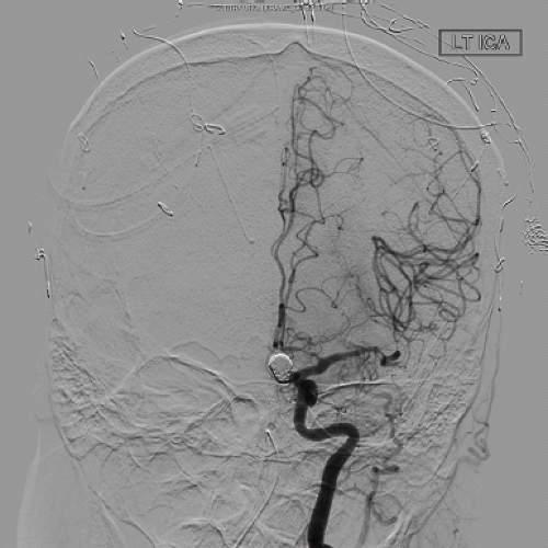 Collateral Flow, Luxury Perfusion, and Vasospasm: Clinical Applications ...