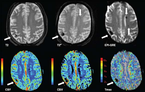 Migraine and Seizures | Radiology Key
