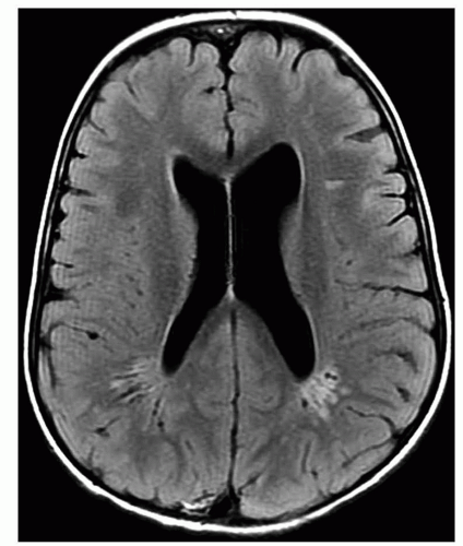 Neurocutaneous Disorders | Radiology Key