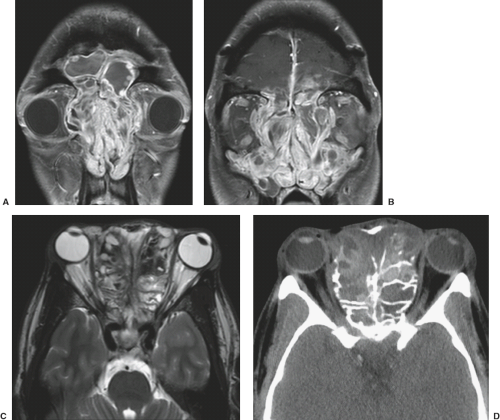 Eye and Orbit | Radiology Key